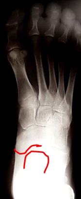 Charcot-Marie Tooth Disease Foot Deformities - FootEducation