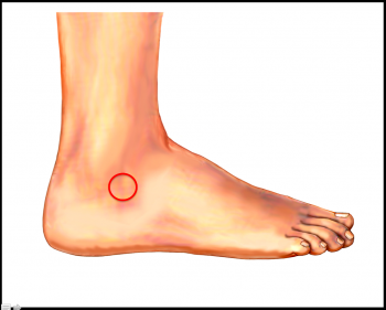 Sinus Tarsi Syndrome - FootEducation