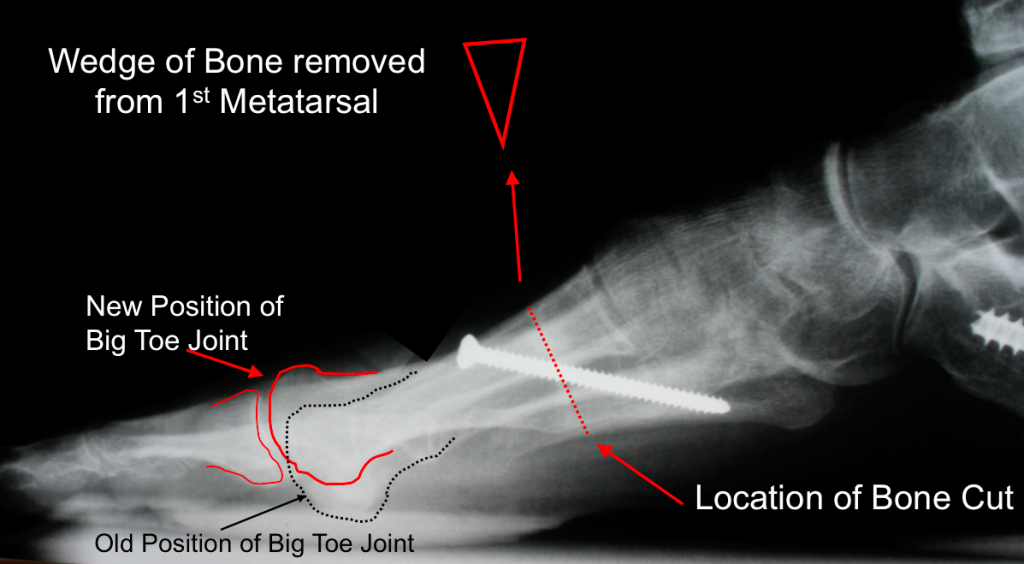 Dorsiflexing 1st Metatarsal Osteotomy - FootEducation