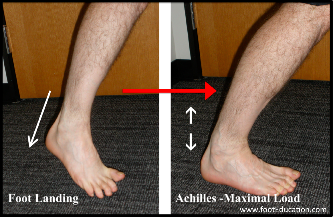Ruptured Achilles Ruptured Achilles