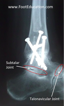 Ankle Fusion - FootEducation