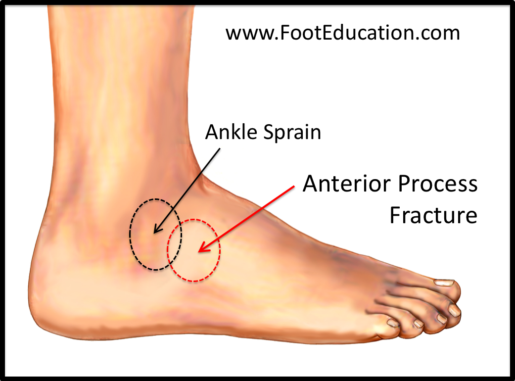 Heel Fracture Treatment Fetibd