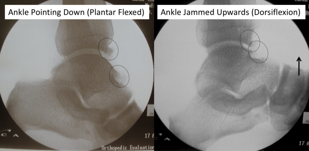 Anterior Ankle Impingement - FootEducation