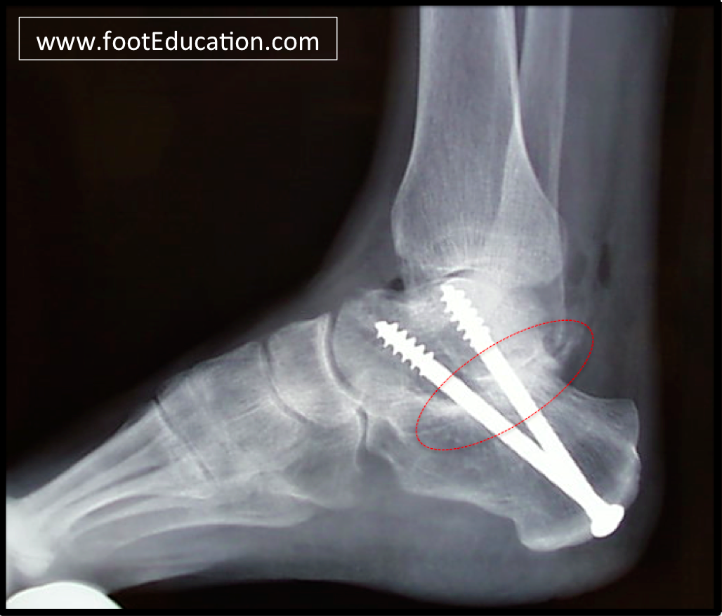 Subtalar Fusion FootEducation Subtalar Fusion FootEducation
