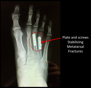 Metatarsal Shaft Fractures - FootEducation