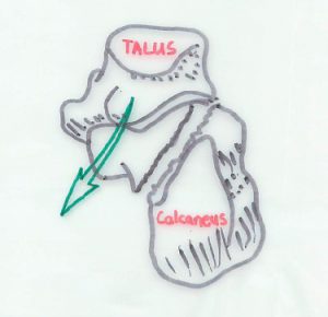 Calcaneal Fractures - FootEducation