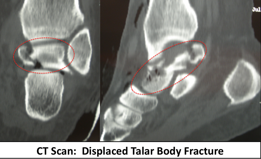 Talar Body Fracture - FootEducation