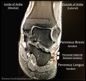 Peroneal Tendonitis - FootEducation