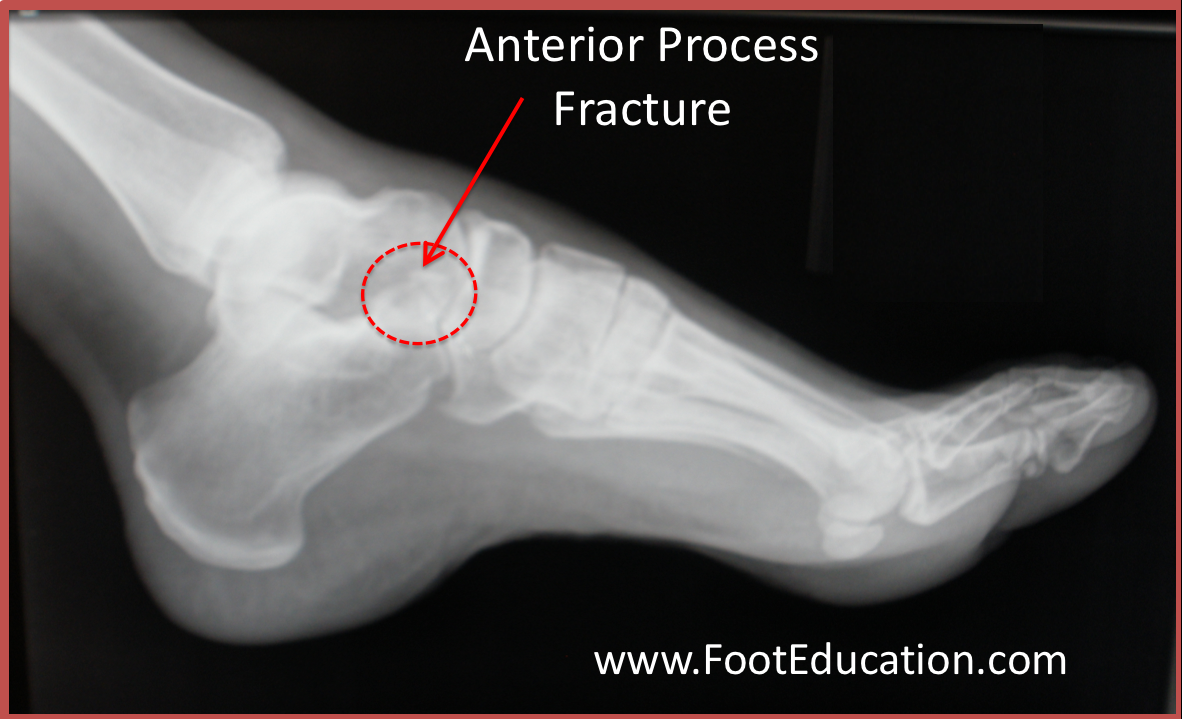 Anterior Process Fracture Of The Calcaneus Footeducation