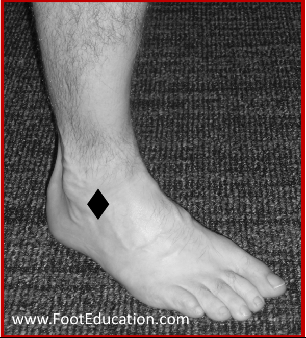 Sprained Ankle - FootEducation