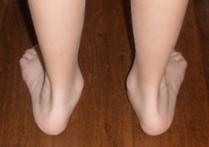 Flexible Flatfeet - FootEducation