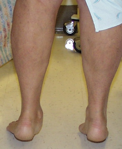 Acquired Adult Flatfoot Deformity - FootEducation