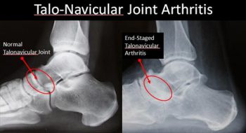 Rheumatoid Arthritis - Talonavicular Joint - FootEducation