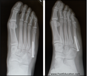 Jones Fracture - FootEducation