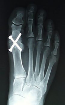 Great Toe Fusion - FootEducation