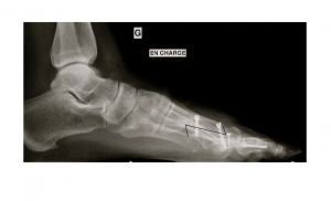 SCARF Osteotomy - FootEducation