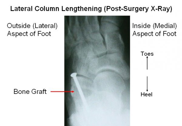 Lateral Column Lengthening - FootEducation