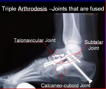 Triple Arthrodesis - FootEducation
