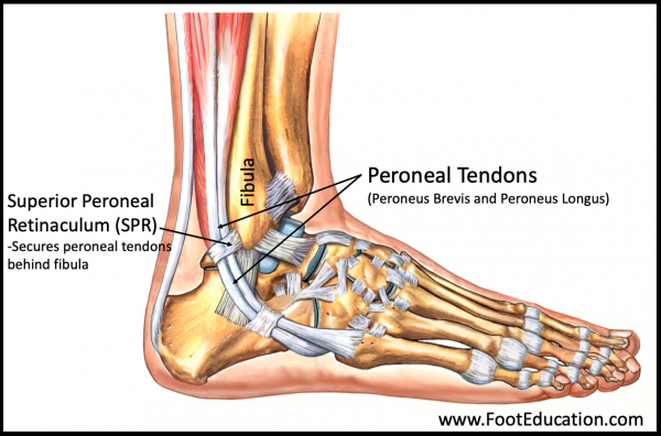 Chronic Peroneal Tendon Subluxation - FootEducation