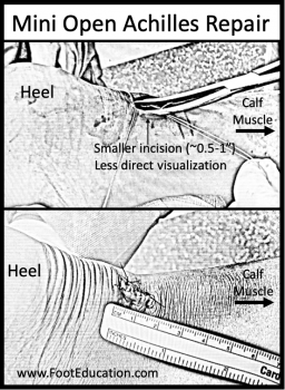 Achilles Tendon Repair - FootEducation