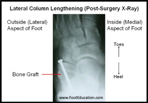 Lateral Column Lengthening - FootEducation