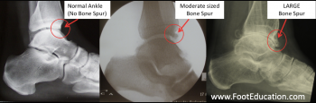 Bone Spurs - FootEducation
