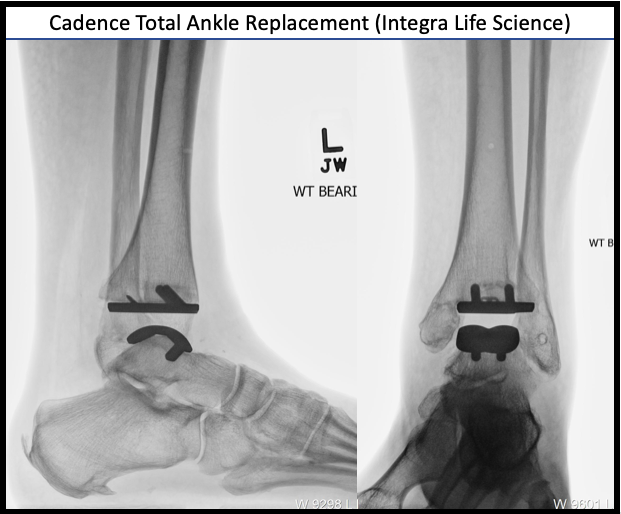 Ankle Replacement - FootEducation