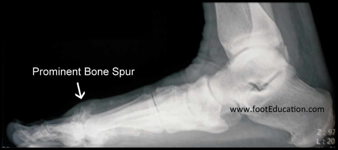 Bone Spurs Footeducation