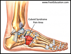 Cuboid Syndrome - FootEducation