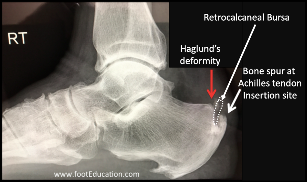 Insertional Achilles Tendonitis - FootEducation
