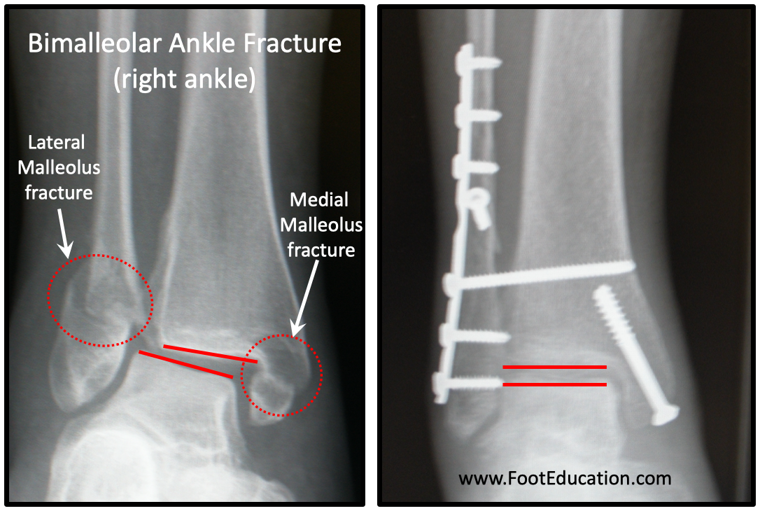 Ankle Fracture ORIF FootEducation
