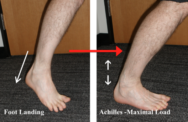 Understanding Achilles Tendon Ruptures - FootEducation