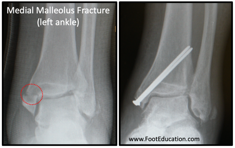 Ankle Fracture Orif Footeducation