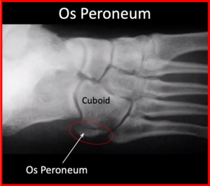 Os Peroneum Syndrome -Painful Os Peroneum - FootEducation
