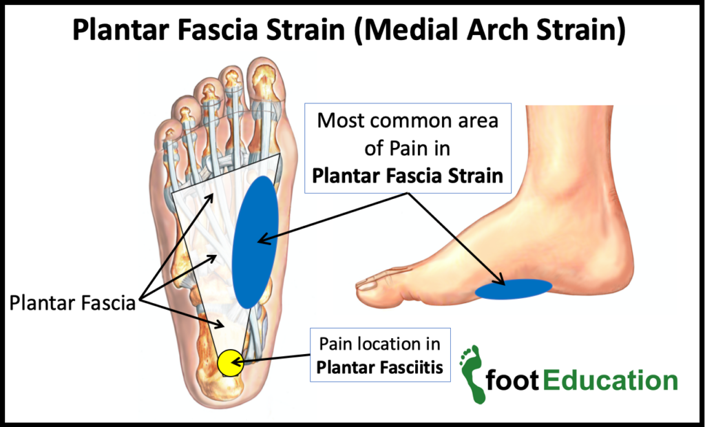 Plantar Fascia Strain Medial Arch Strain FootEducation Plantar Fascia Strain Medial Arch Strain FootEducation