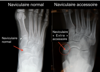 Os Naviculaire Accessoire - FootEducation