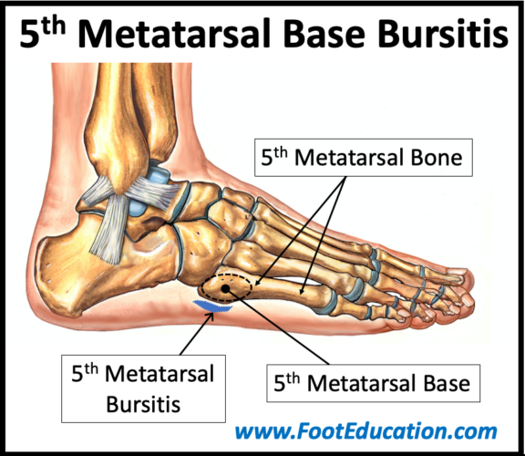 Fifth Metatarsal Base Bursitis - FootEducation