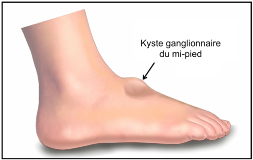 Kystes ganglionnaires - FootEducation