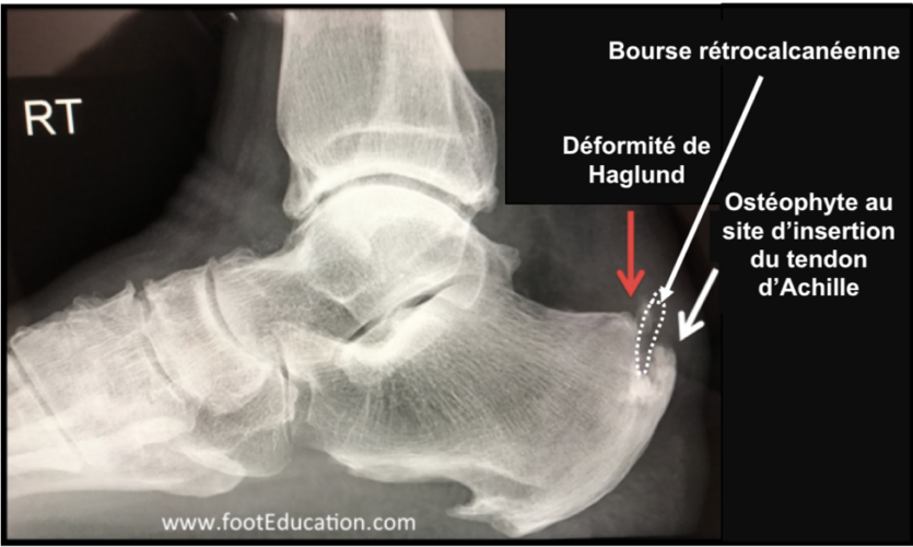 La tendinopathie insertionnelle du tendon d’Achille - FootEducation