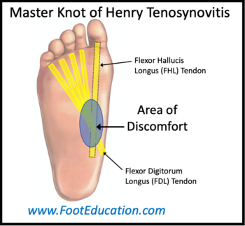 Master Knot of Henry Tenosynovitis - FootEducation