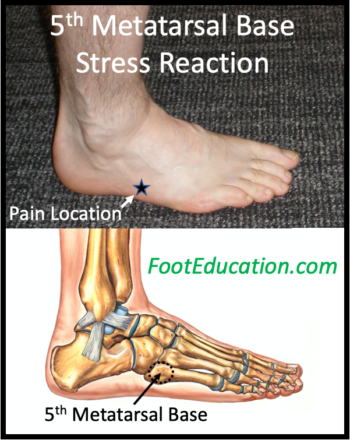 Fifth Metatarsal Base Stress Reaction - FootEducation