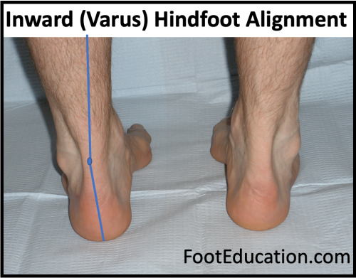 Characteristics of a High Arched Foot - FootEducation