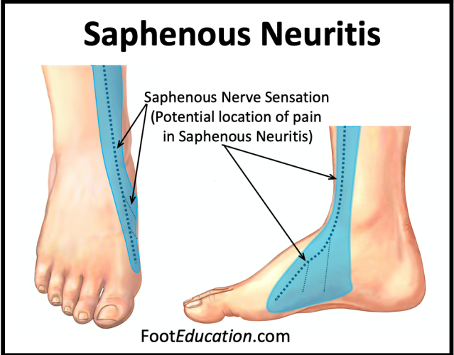 Saphenous Neuritis - FootEducation