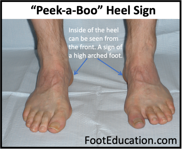 Characteristics of a High Arched Foot - FootEducation