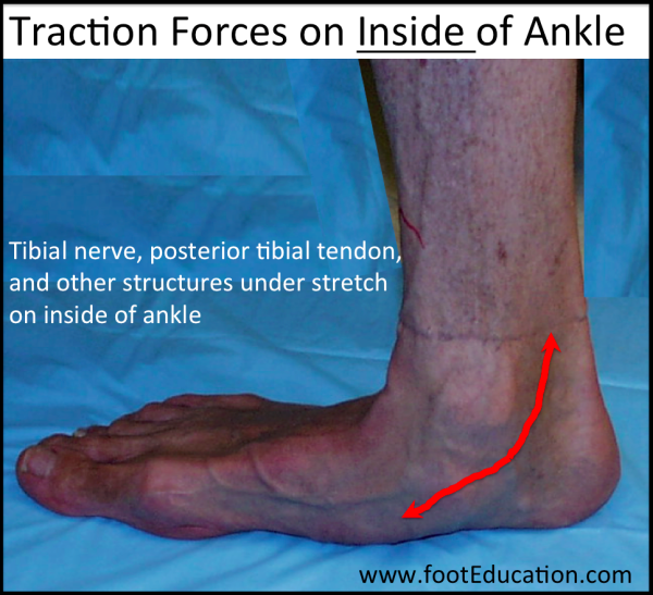 Characteristics of a Flat Foot - FootEducation