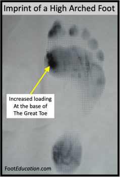 Characteristics of a High Arched Foot - FootEducation