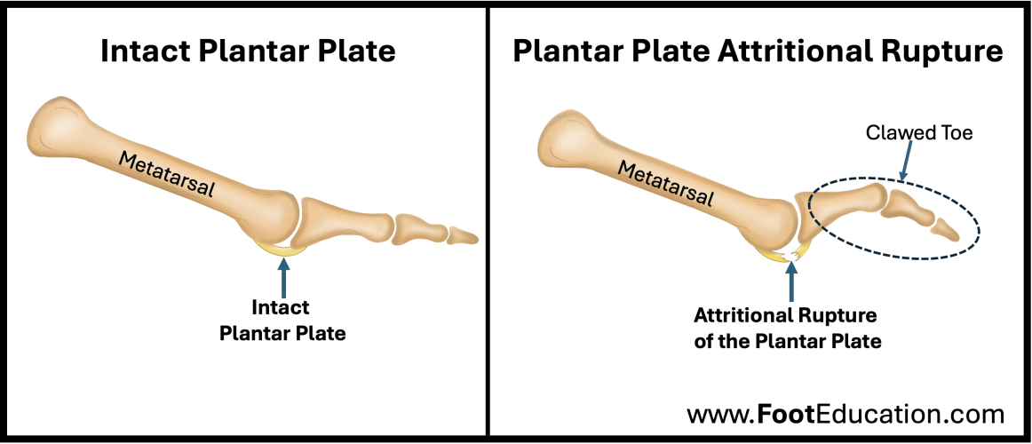 Attritional Plantar Plate Rupture – Chronic Plantar Plate Tear ...