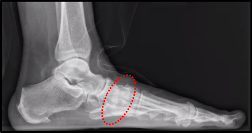 Midfoot Arthritis - FootEducation