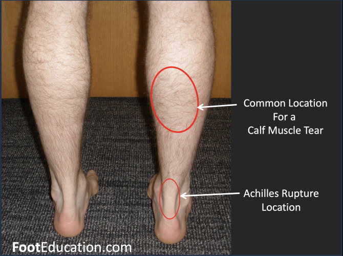 Calf Tears, Achilles Ruptures, Achilles Tendonitis, and Plantar ...