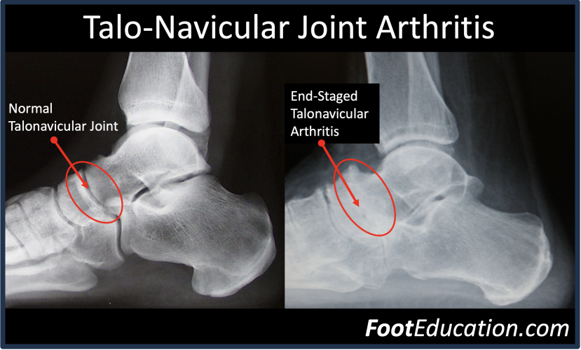 Talonavicular Arthritis - FootEducation